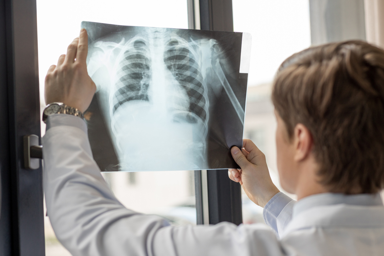 Quest Ce Que La Dilatation Des Bronches Ou Dcp Symptômes Et